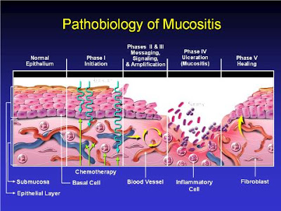 50 sombras de Gy: ¿Qué es la mucositis oral?